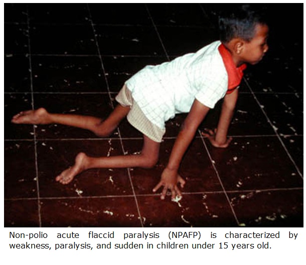 NCDC Confirms 214 New Cases Of Acute Flaccid Paralysis NCDC Confirms 214 New Cases Of Acute Flaccid Paralysis